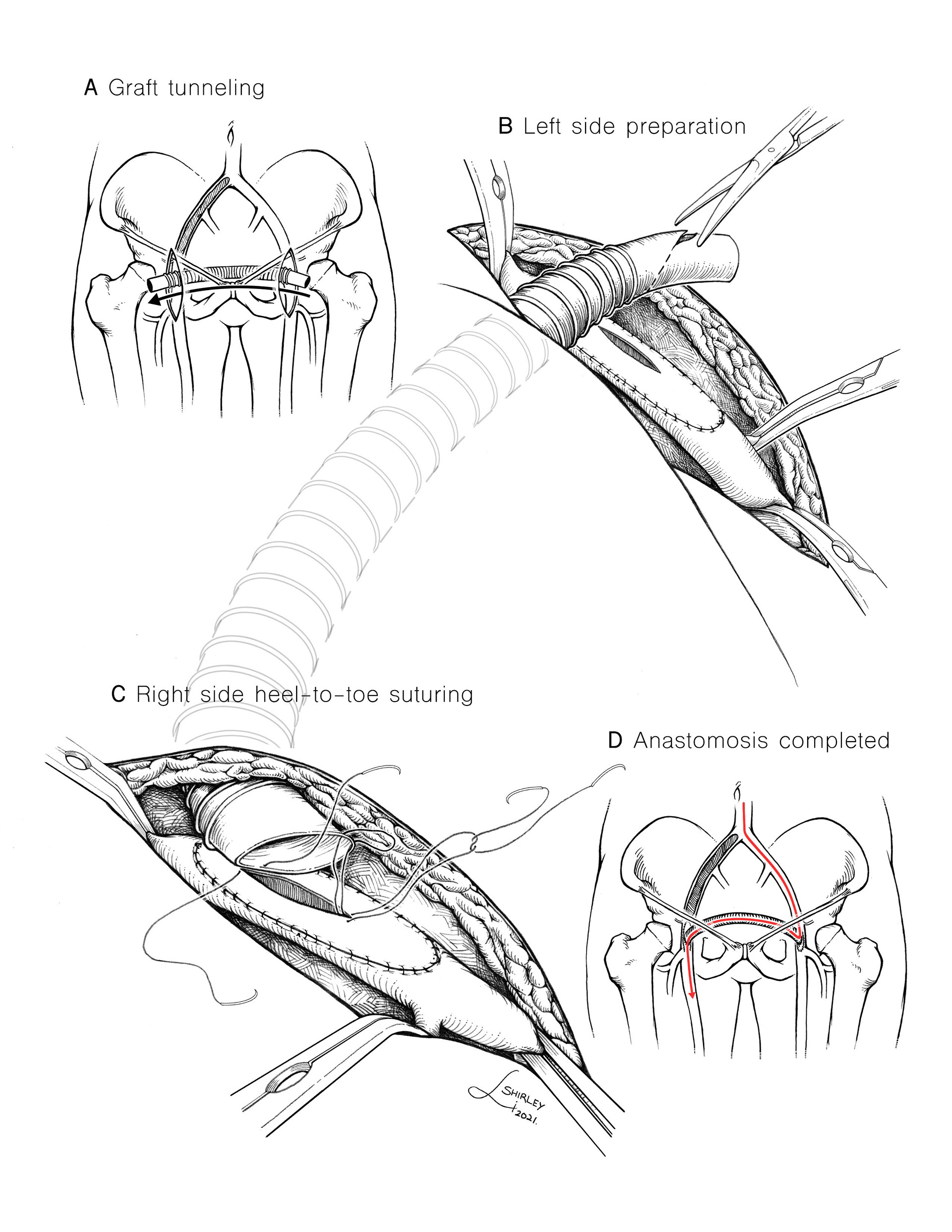 Shi Yao Li - Femoro-femoral Bypass Shi Yao Li - Femoro-femoral Bypass