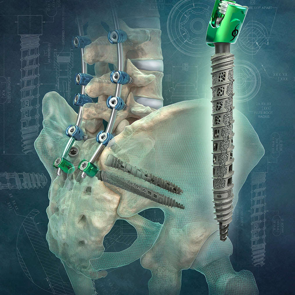 Medical Illustration Certified Medical Illustrator Ifuse Implant System