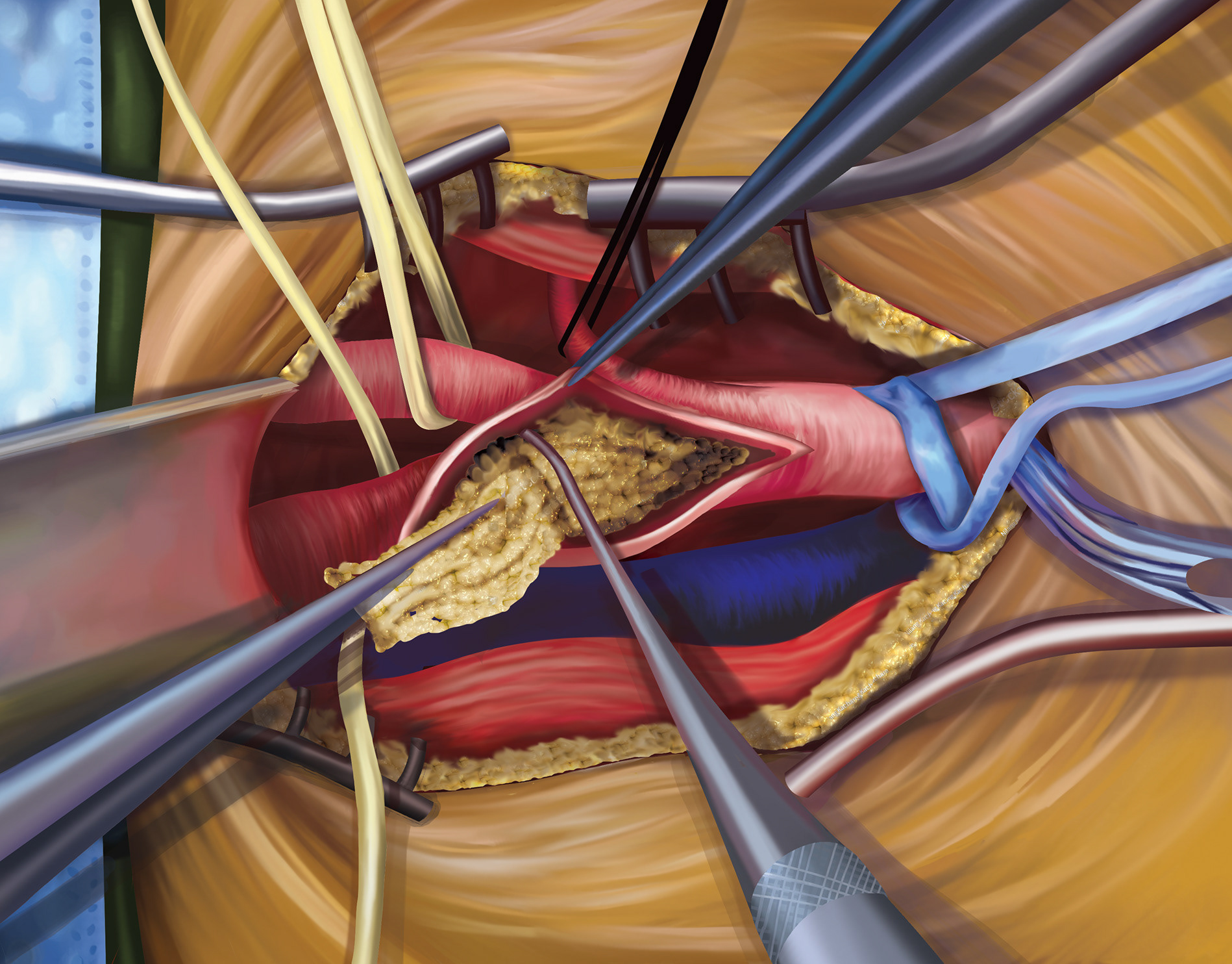 Kasey Portanova Surgical Illustrations kasey-portanova-surgical-illustrations