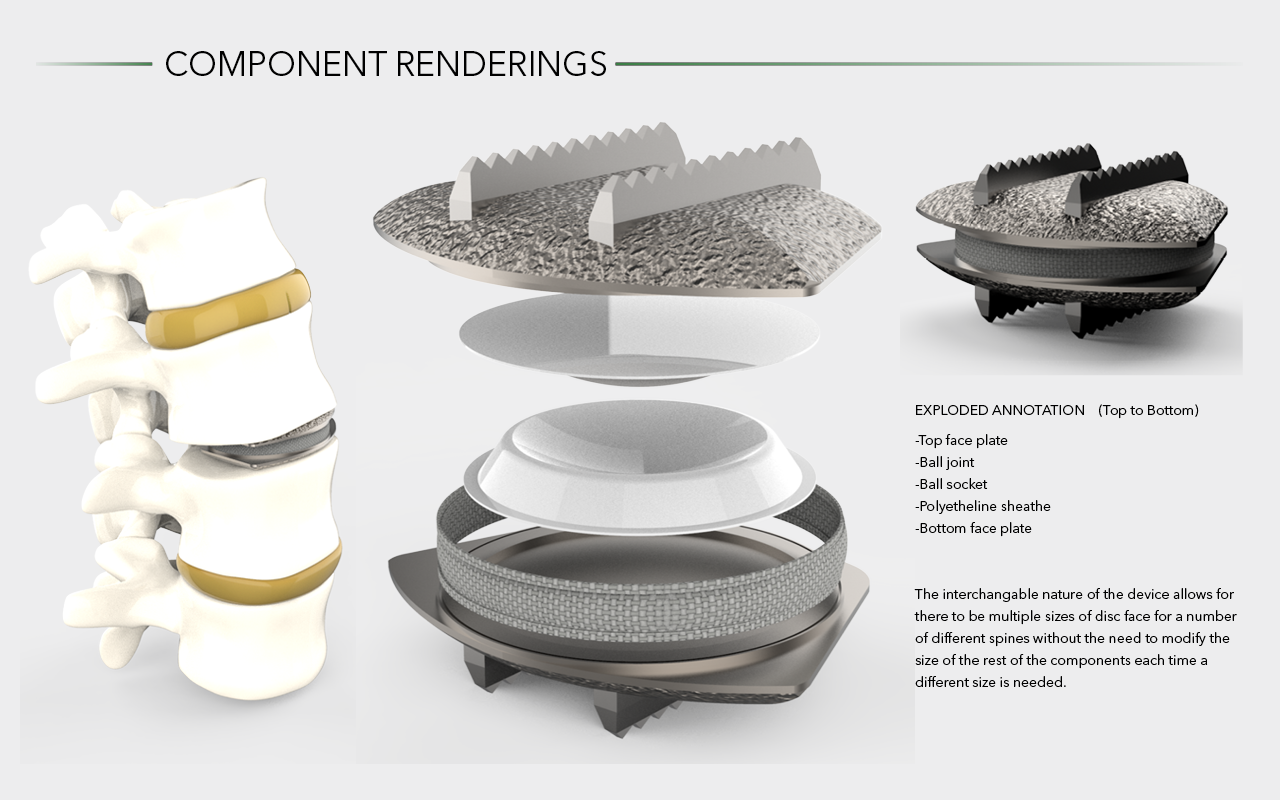 Patrick McMahon - SPINAL PROSTHETIC