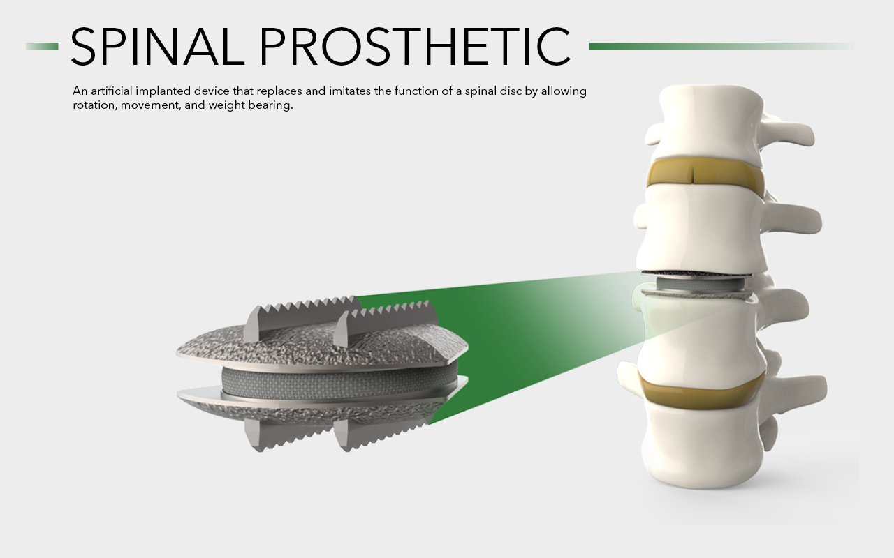 Patrick McMahon - SPINAL PROSTHETIC
