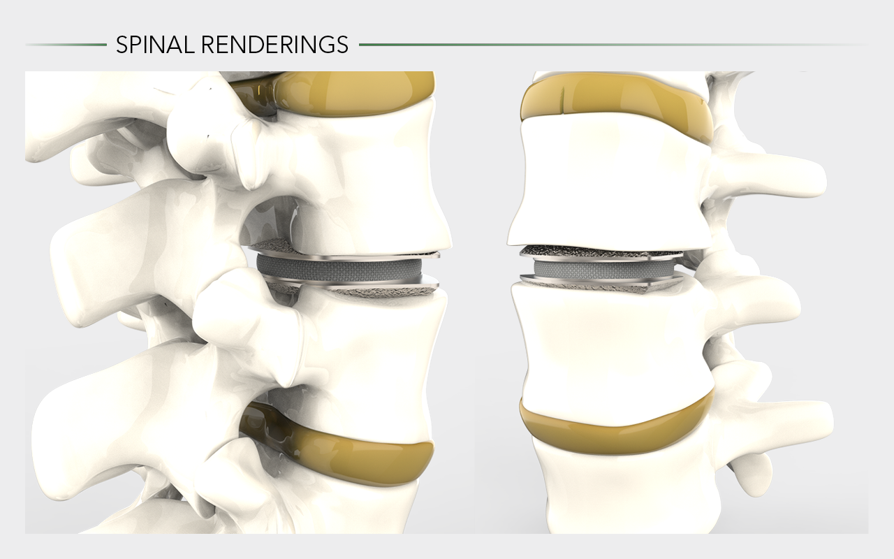 Patrick McMahon - SPINAL PROSTHETIC