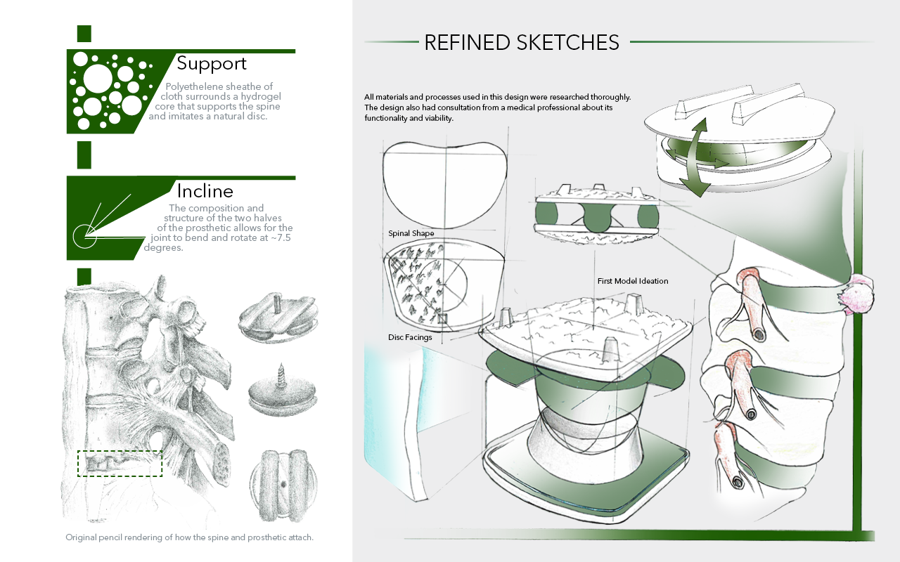 Patrick McMahon - SPINAL PROSTHETIC