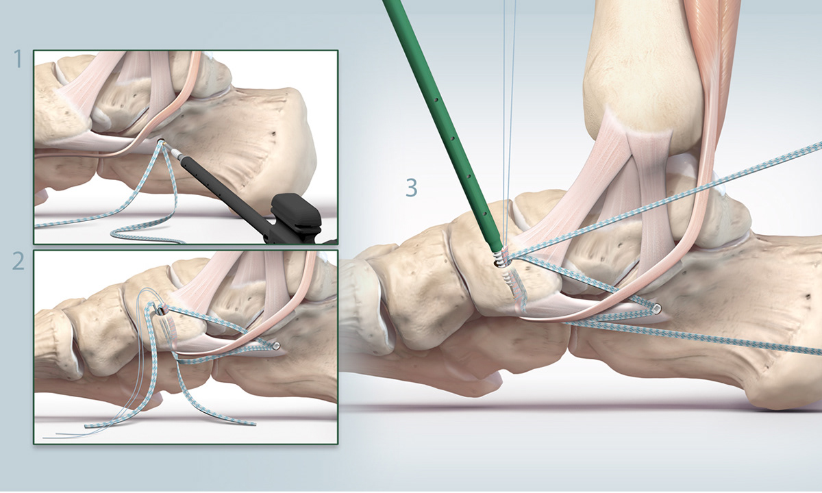 Eckhold Biomedical Illustration - ATFL LIGAMENT REPAIR